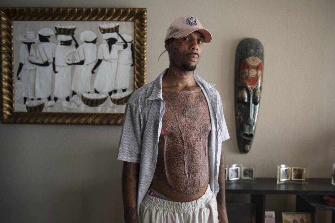 Man burned on pavement: 'Nobody's supposed to live like this ...