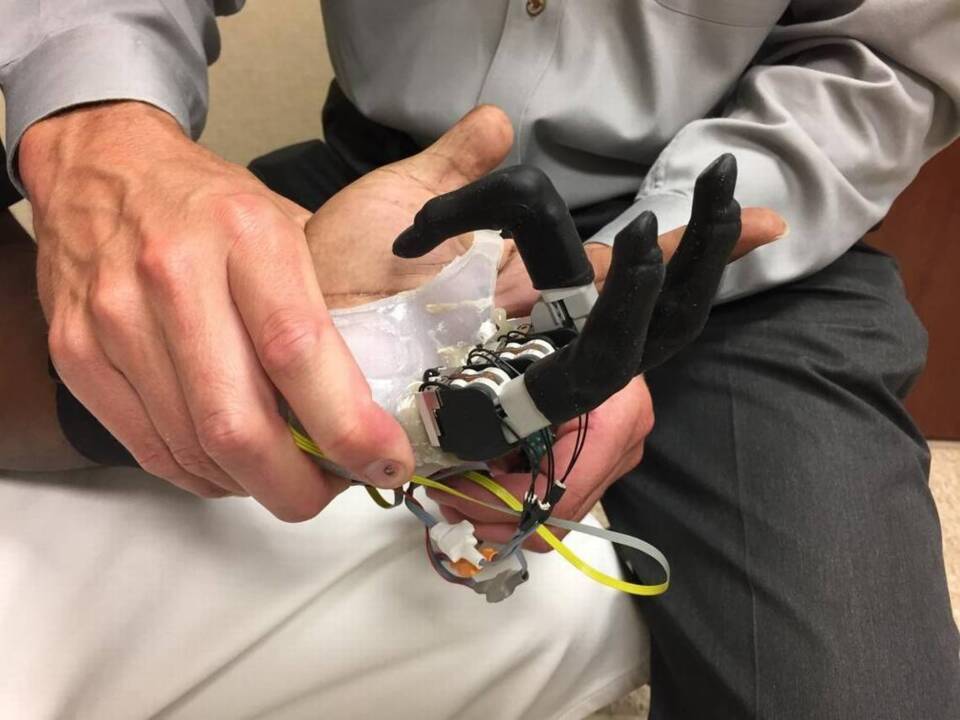 A helping hand for man who lost fingers | Charlotte Observer