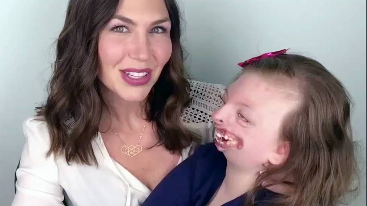 Cornelius Nc Girl Trolled Online For Facial Deformities Dies