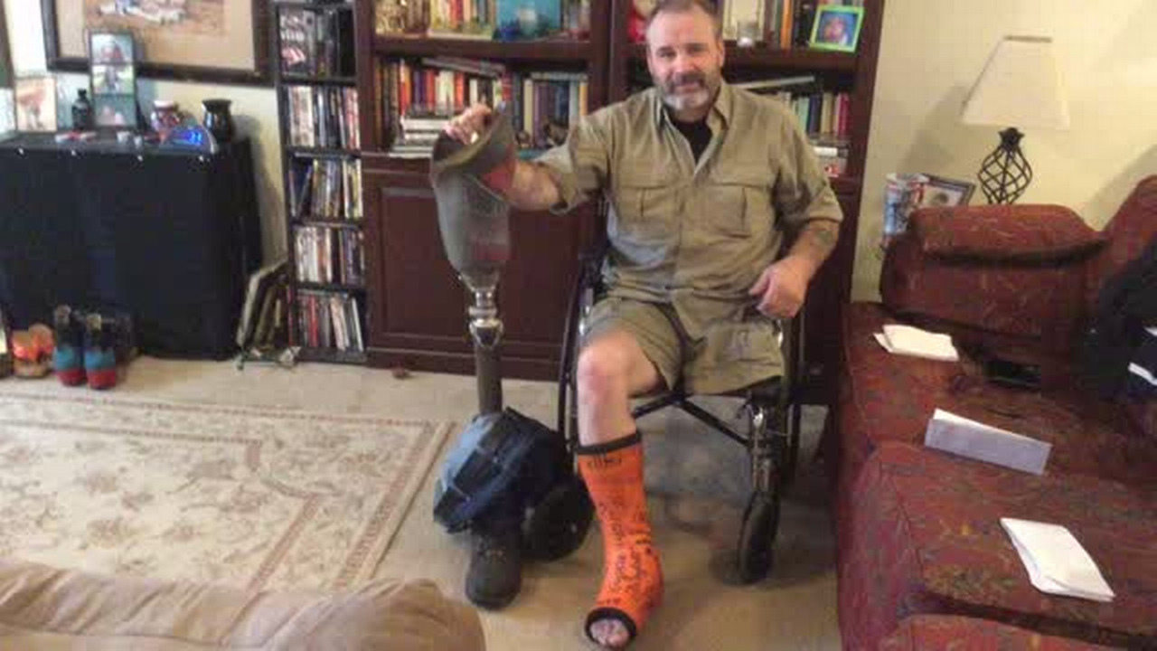 Rock Hill man with one leg breaks it and can't work | Rock Hill Herald