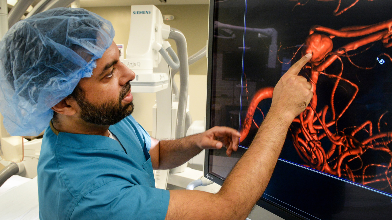 Woven EndoBridge (WEB) aneurysm embolization system used to treat ...