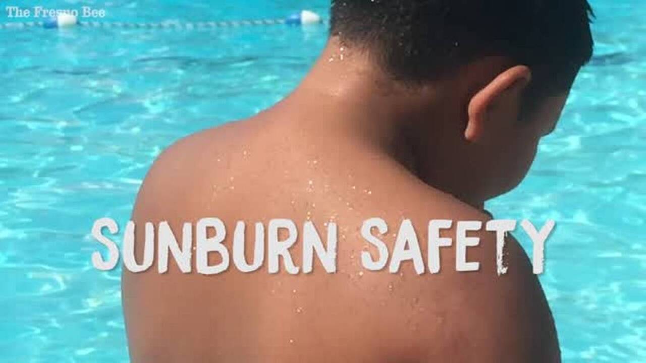 Sunburn safety, treatment tips | Fresno Bee