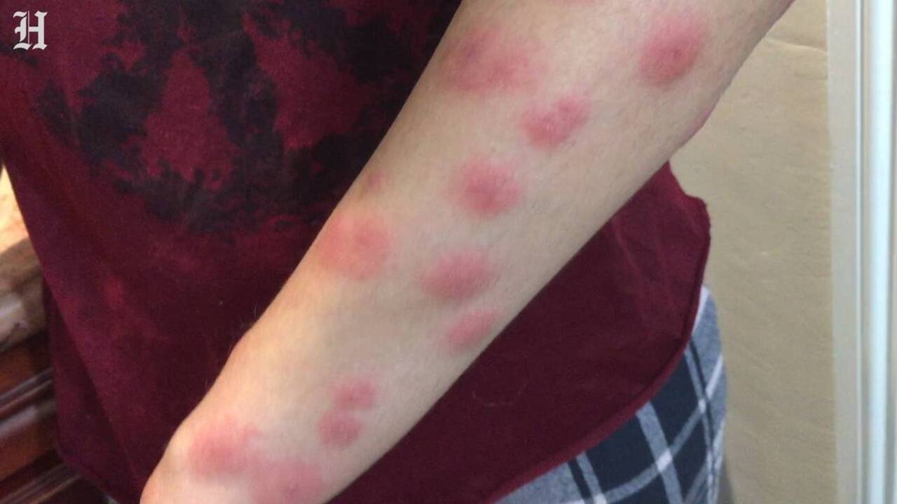 Miami woman suffered more than 100 bed bug bites at Atlantis in the ...