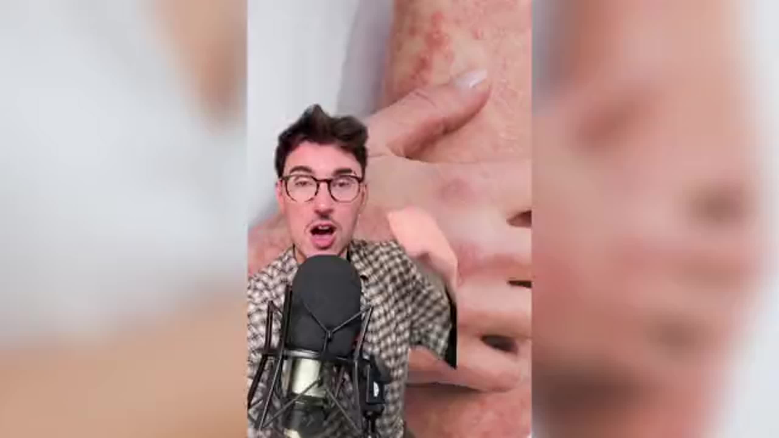 Shingles Is A Painful Rash That Happens In One-Third Of Adults. Here's ...