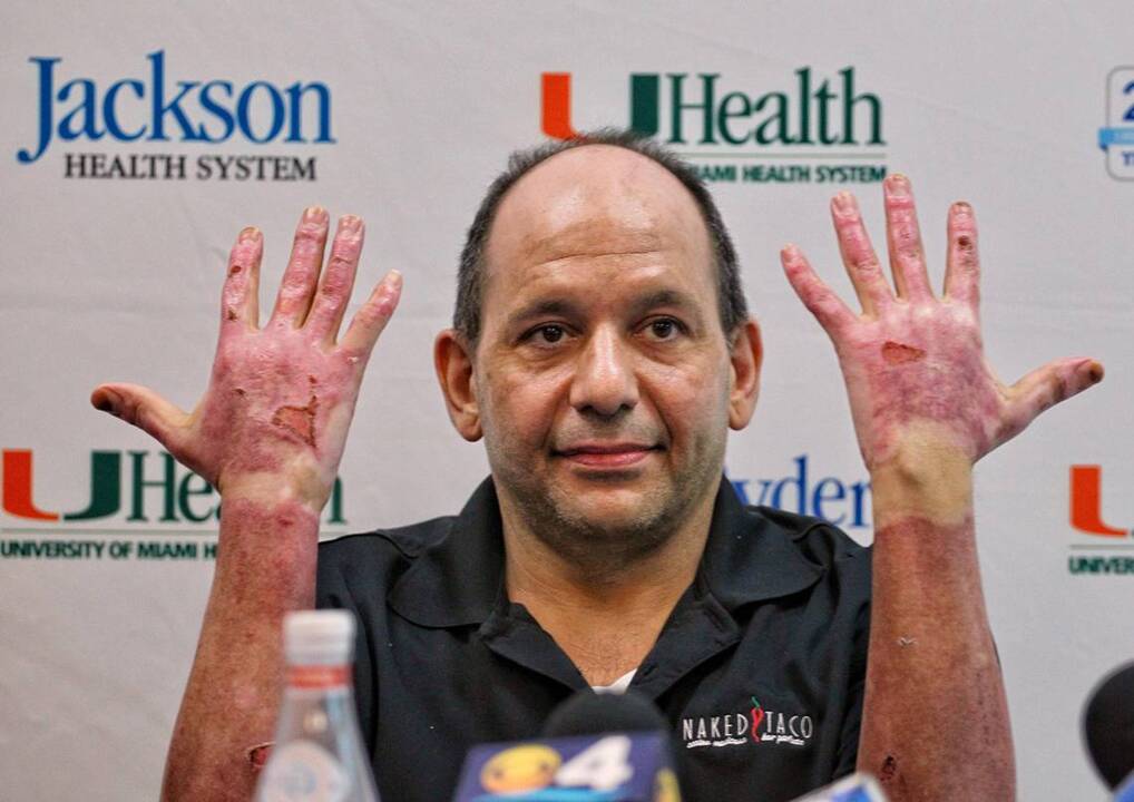 Chef Ralph Pagano released from burn unit | Miami Herald